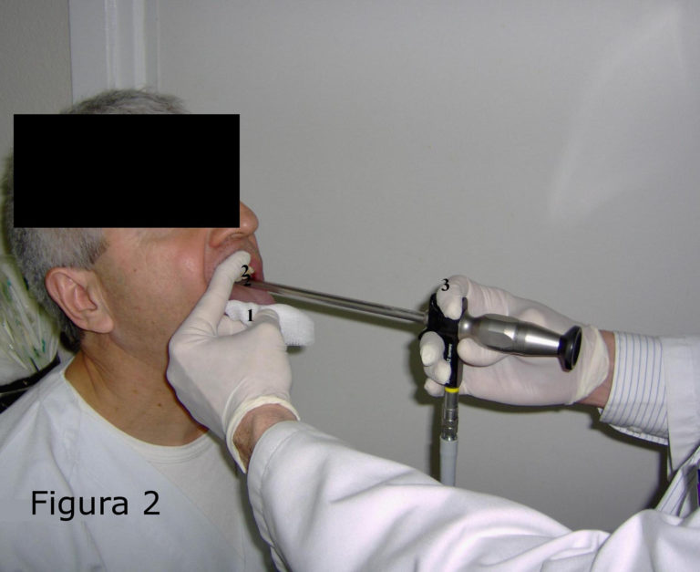 Exploración con el Laringoscopio Rígido de la Vía Aérea Superior.